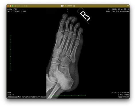 5th Metatarsal Head Fracture R Brokenbones