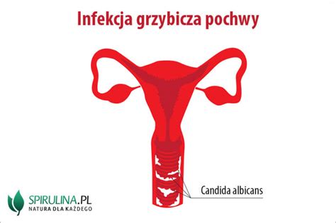 Infekcja Grzybicza Pochwy Algi Spirulina I Chlorella