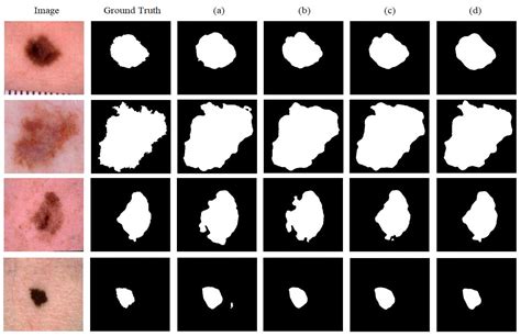 An Improved Multi Scale Feature Fusion For Skin Lesion Segmentation