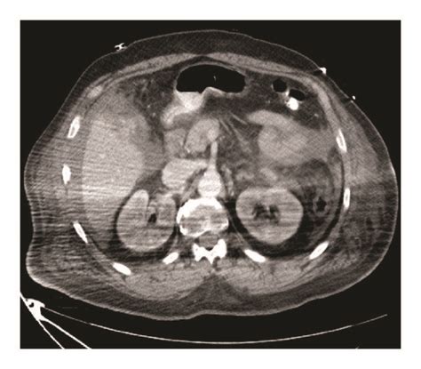 Ct Scan Of Abdomen And Pelvic Showing Hemoperitoneum And Mass Like