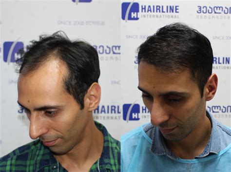 Hairline International