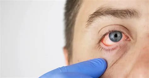 Viral Pink Eye Remedy Relief Without Medication