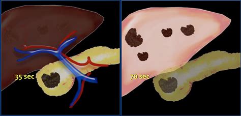 The Radiology Assistant Ct Contrast Injection And Protocols