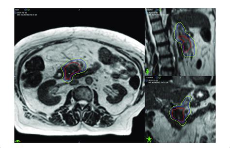 Target Volumes Of A Patient With Pancreatic Head Uncinate Process Download Scientific Diagram
