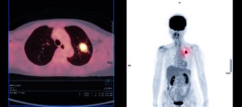 Pet検査薬剤影響中止薬 Pet検査 食事制限 Pet Ct 検査を受ける際の注意事項 Afvss