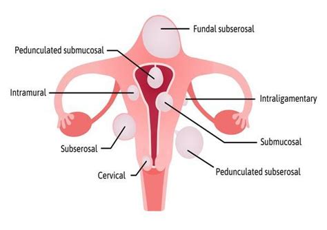 Fibroid Symptoms Symptom Free With Ufe Minimally Invasive Solution