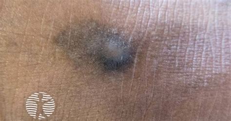 Nodular Prurigo Image