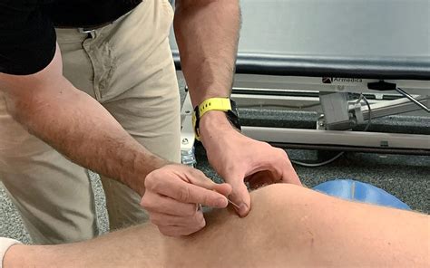 What Is Dry Needling Strive Physical Therapy
