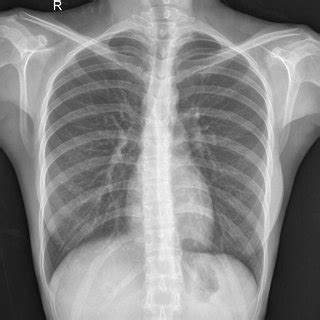Normal Chest X Ray Images Lung Heart And Diaphragm Are Clearly
