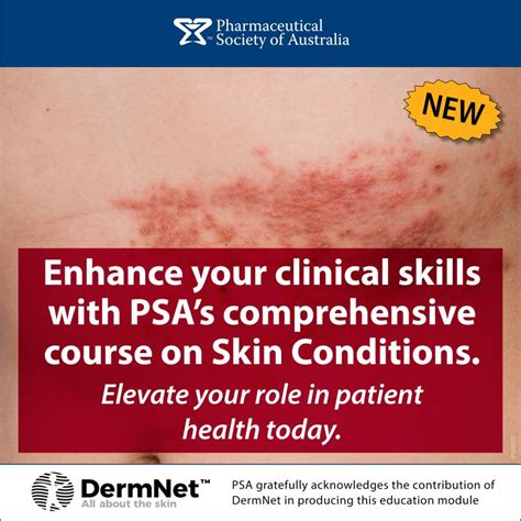 Mild Plaque Psoriasis And Herpes Zoster Shingles Vic Jarrod Mcmaugh