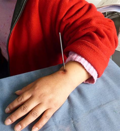 Revision Casos De Cirugia General OTRO CASO DE LESION PENETRANTE