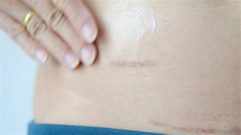 Using Cream To Care For Scars After Appendix Surgery 32326490 Stock