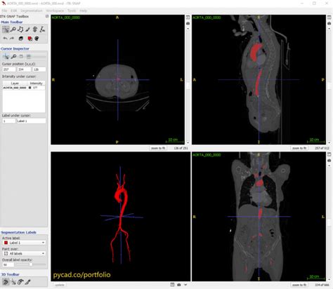 Mohammed El Amine Mokhtari On Linkedin How I Use Nnunet For Medical