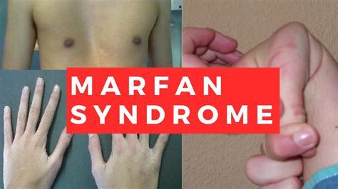 Marfan Syndrome Causes Symptoms Prognosis Diagnosis T