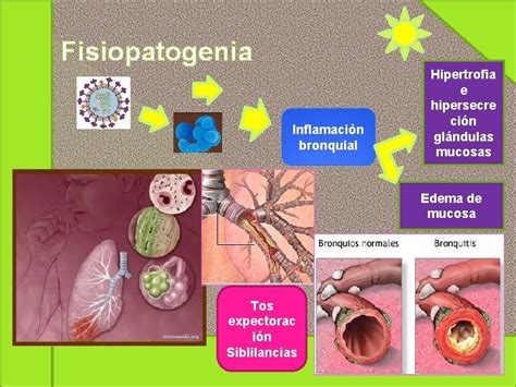 Bronquitis Aguda Jimnez Villa Sheila Itzel 6 C