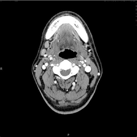 Figure 2 From Bilateral Cervical Lymphadenopathy After Mrna Covid 19
