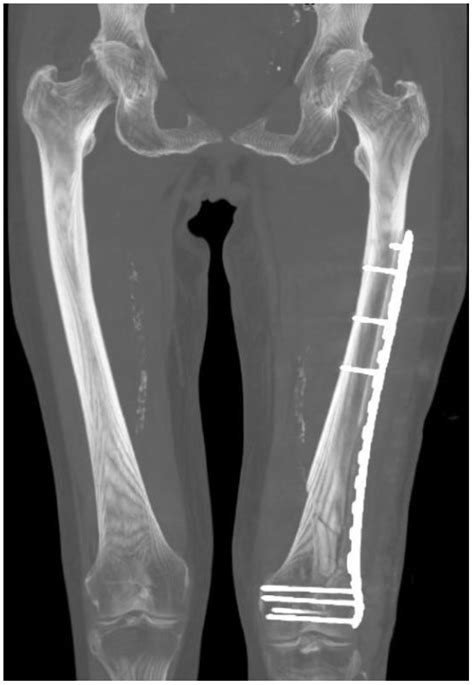 Fracture Table At Albert Prowell Blog