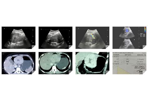 Vietnamese Medic Ultrasound Case 437 Liver Tumor Dr Phan Thanh HẢi