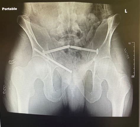 Fractured Pelvis In 4 Places Something Tells Me Hell Be Just Fine