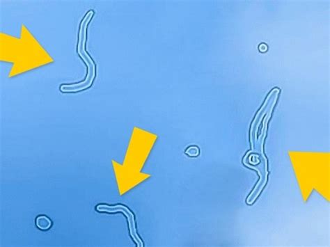 Clear Floaters In Vision