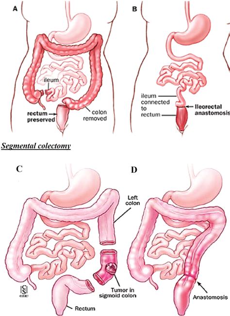 Schematic Illustrating The Method Of Total Abdominal Colectomy Vs