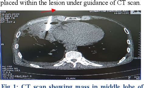 Pdf Histopathologic Analysis Of Ct Guided Core Needle Biopsy In