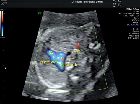 Aberrant Right Subclavian Artery Arsa Hkog Info