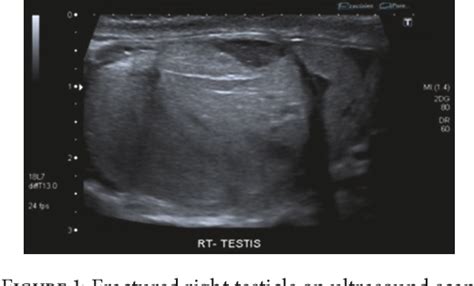 Figure 1 From Testicular Rupture Or Testicular Fracture A Case Report And Literature Review
