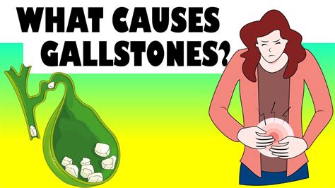 What Causes Gallstones Major Causes Of Gallstone Disease Gallstones