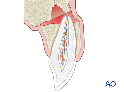 Alveolar Fracture Segmental