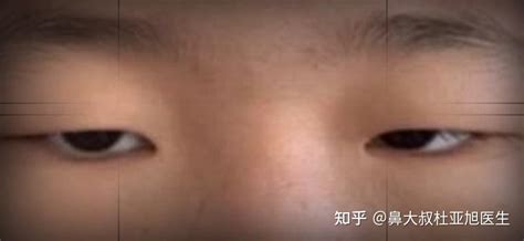 上睑下垂做双眼皮能改善吗？ 知乎