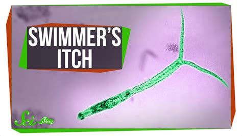 The Horrifying Truth About Swimmers Itch Youtube