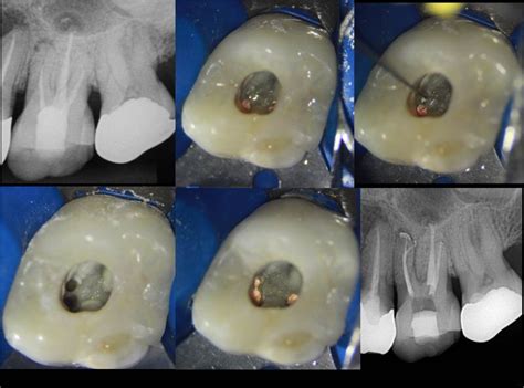Locating The Second Mesiobuccal Canal In Maxillary Molars Challenges