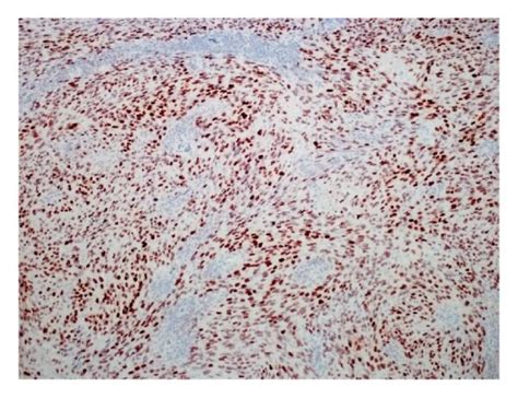 Diffuse Positive Staining Of Tumor Cells Immunohistochemically With A