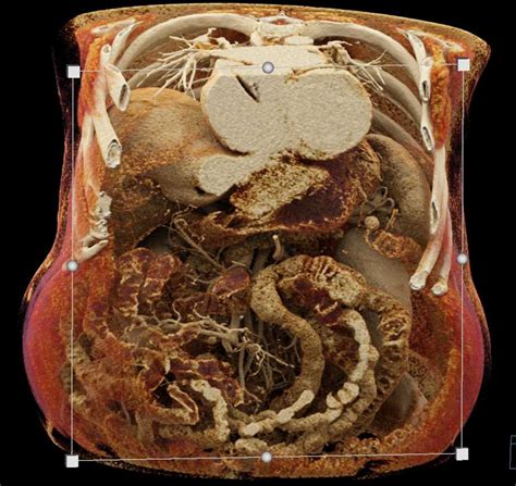 Gastric Gist Tumor Stomach Radiology Case Studies Ctisus Ct Scanning Gastric Gist Tumor Stomach Radiology Case Studies Ctisus Ct Scanning