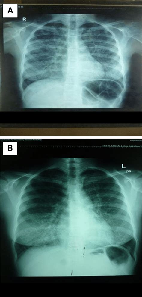 A Chest Radiograph Demonstrated Reticular Nodular Pattern Of Bilateral Download Scientific
