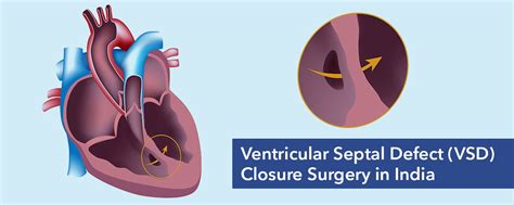 Vsd Surgery Cost In India Vsd Closure Surgery Cost In India
