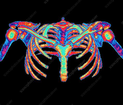 Rib Cage Ct Scan Stock Image P1160459 Science Photo Library