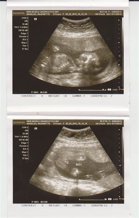 Our Infertility Battle My Congenital Anomaly Scan C A S