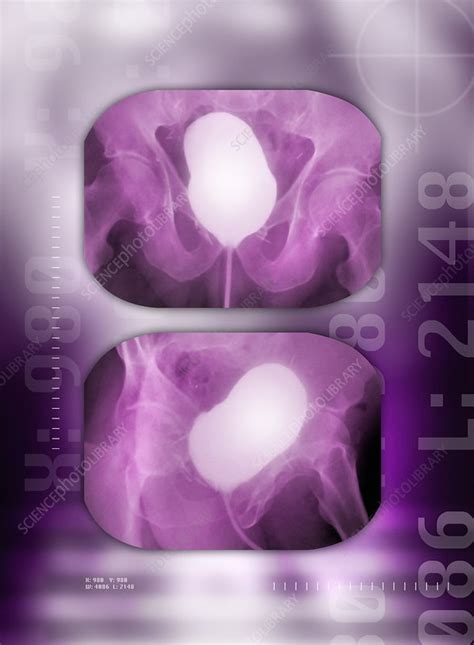 Healthy Bladder Cystogram X Ray Stock Image P5560092 Science