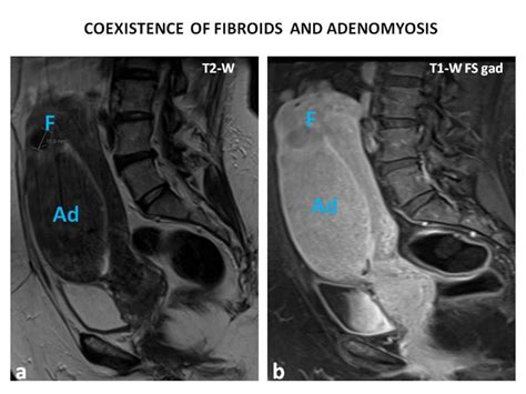 Coexistence Of A Fibroid And Adenomyosis In A 54 Year Old Woman Download Scientific Diagram