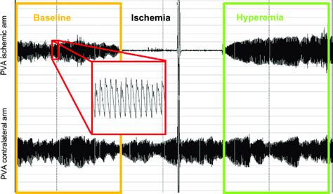 Recording From A Peripheral Arterial Tonometry Test The Baseline Download Scientific Diagram