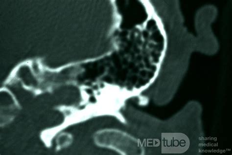 Pedunculated Osteoma Of The External Canal Axial Ct Scan • Image