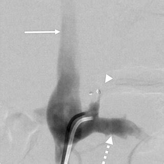 Transverse Gray Scale Ultrasound Of The Abdomen Immediately After Plug