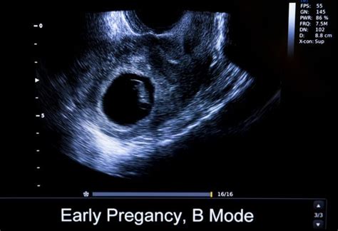 How Accurate Are Dating Scans At 9 Weeks How Accurate Is A Dating