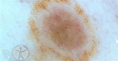 Dermoscopy Image