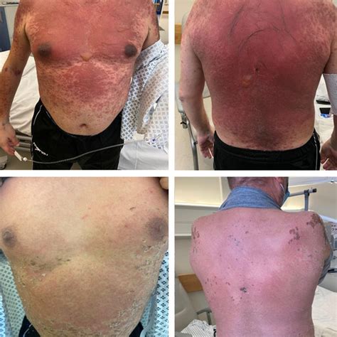 Extensive Erythema And Blistering On The Chest Back Upper Limbs And