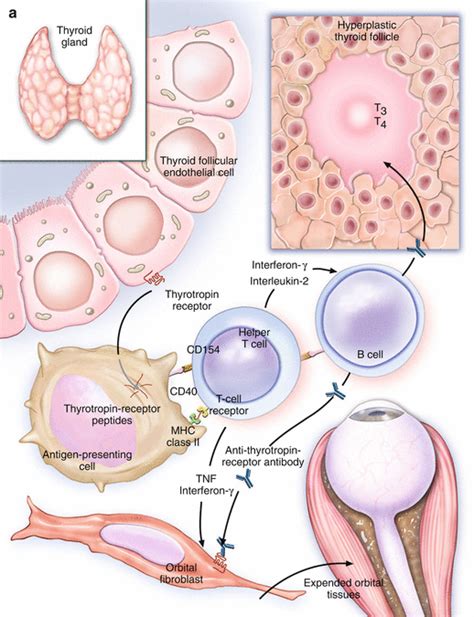 Management Of Dysthyroid Optic Neuropathy Ento Key
