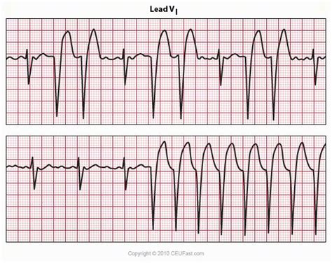 Irregular Regular Rhythm