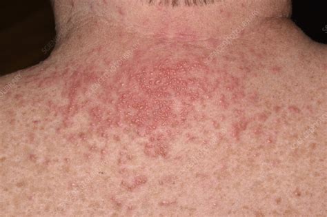 Redness On Neck And Upper Chest Eczematous Rash On The Back Of A Mans